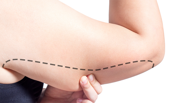 Arm lift – Ramo Clinic